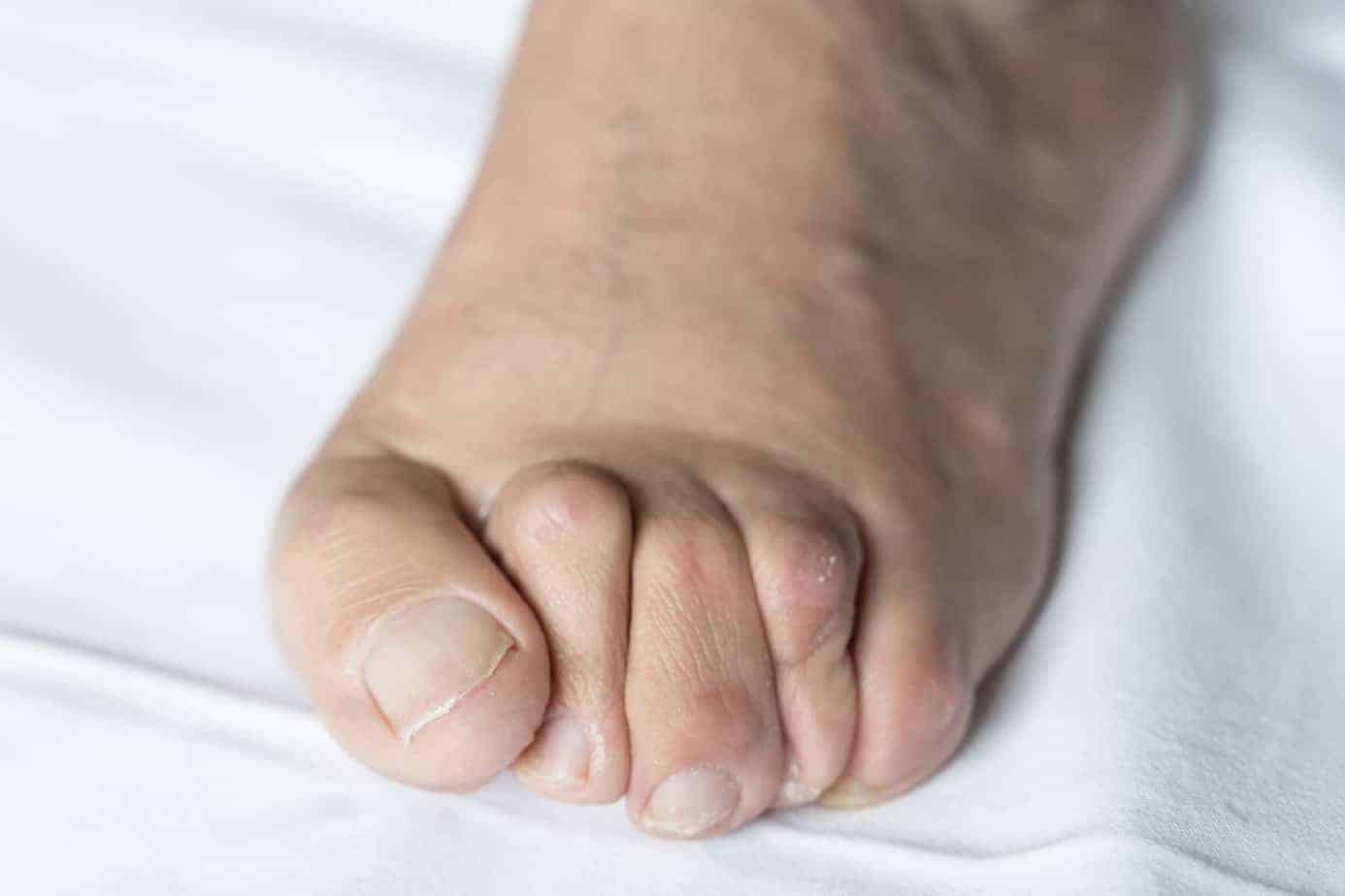10 Most common diabetes foot problems and how to avoid them